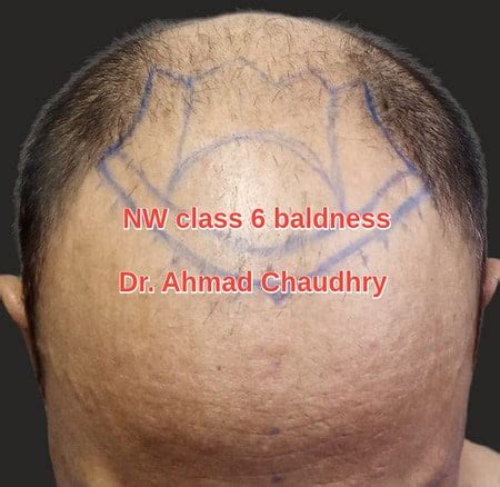 Hair Transplant Lahore Prices 70 Rs Per Graft Free Estimate Call Us