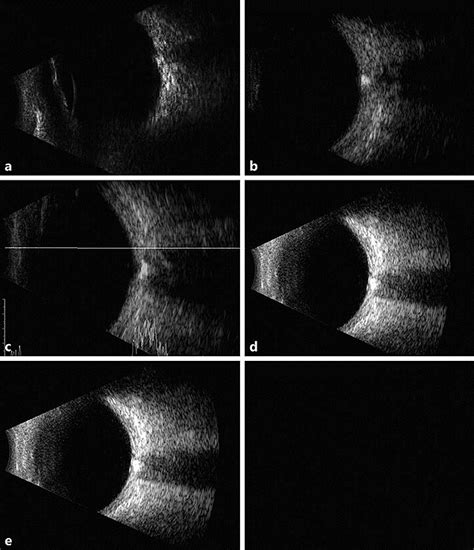B Scans Demonstrating Calcification And Posterior Shadowing From Onh
