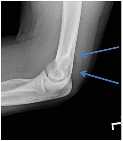 Olecranon Fossa X Ray