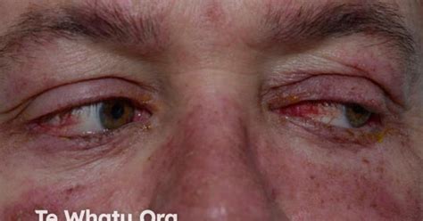 Sjs Ten Ocular Image