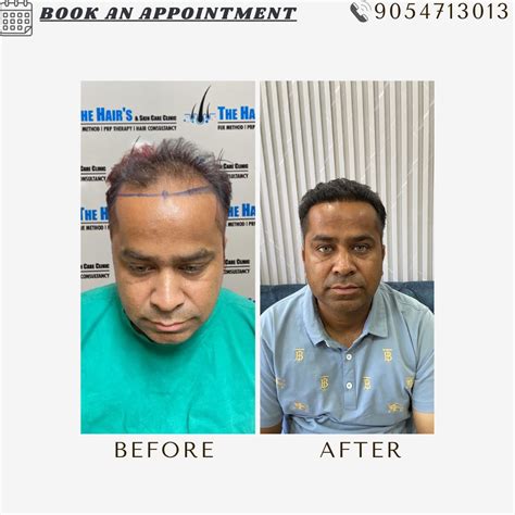 Best Hair Transplant Results The Hairs And Skin Care