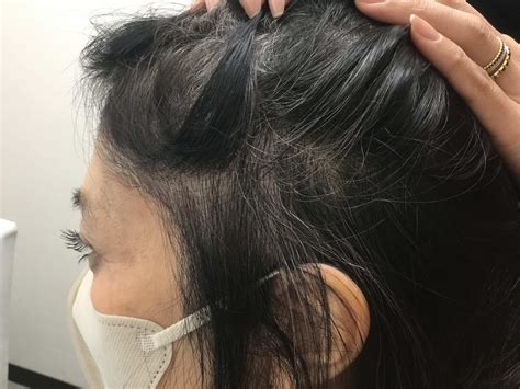 症例一覧円形脱毛ラボ