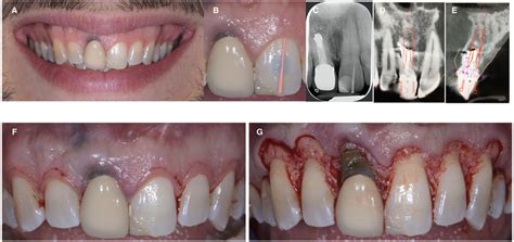 Case 2 A Baseline Situation Showing Dark Root Discoloration And