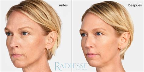Tratamiento De Radiesse En Zaragoza Rejuvenece Tu Rostro Sin