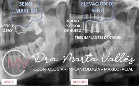 Tratamiento de elevación del seno maxilar Clínica Marta Vallés