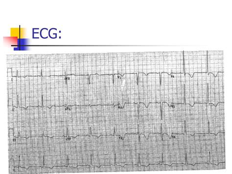 Ppt The Ecg And Toxicology Powerpoint Presentation Free Download
