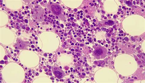 Myelodysplastic Syndrome