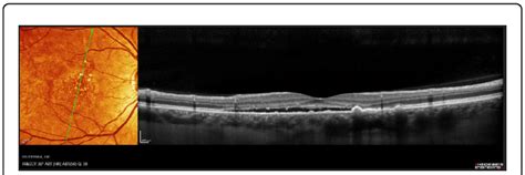 A Sd Oct In A 58 Years Old Woman With Csc In His Right Eye Lasting