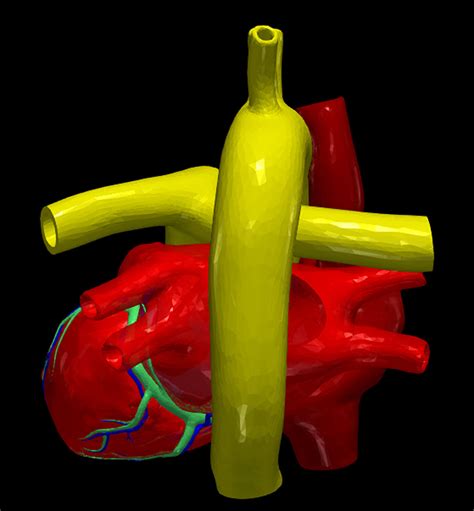 3d Model Of Common Arterial Trunk Truncus Arteriosus By Azekapeka