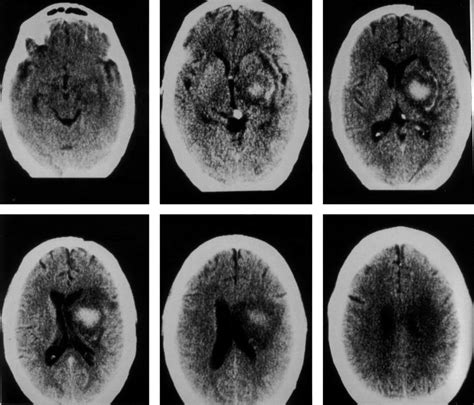 Ct Scan Cerebral Hemorrhage In The Left Capsular Lenticular Region