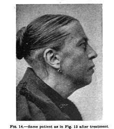 Hypothyroidism In Pictures Functional Performance Systems FPS