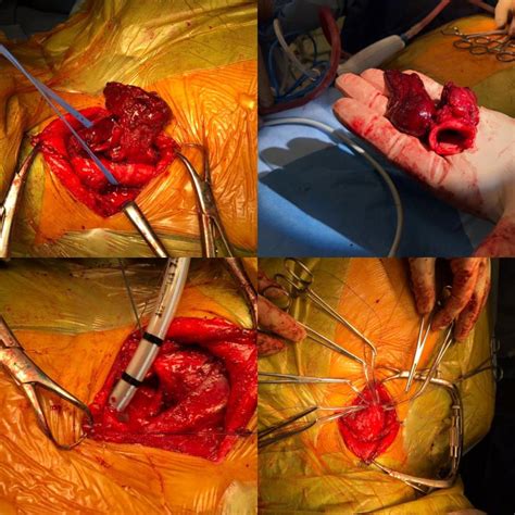 A Prof Gavin Wright Mbbs Fracs Phd On Linkedin Cancer Trachea Surgery