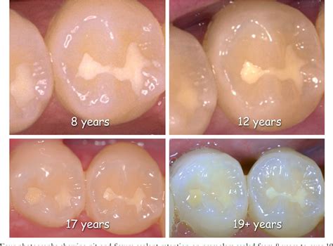 What Is Fissure Sealant In Dentistry At Audrey Stier Blog