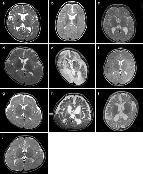 Mri Findings With Persistent White Matter Lesion Axial T2wi For 10 Download Scientific Diagram