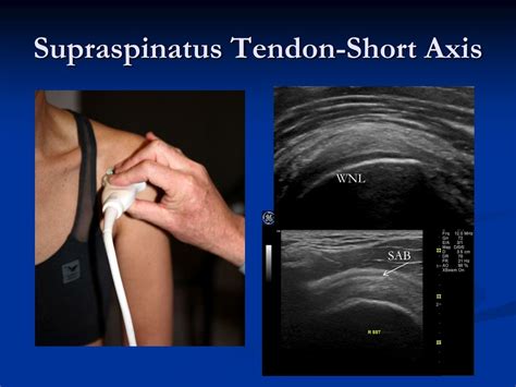 Ppt Comprehensive Guide To Musculoskeletal Ultrasound Of The Shoulder