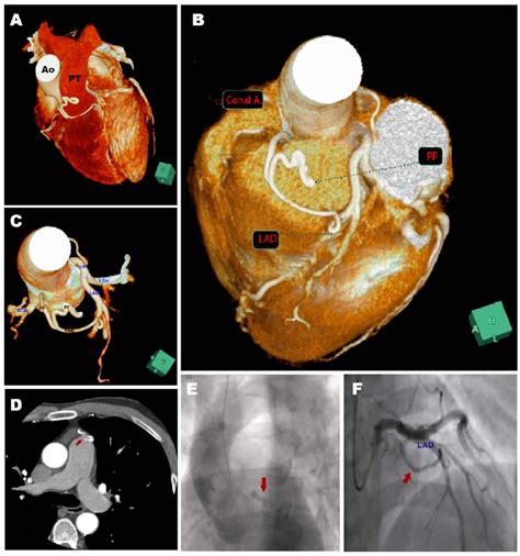 CCTA Volume Rendering Reconstruction A C Depicts The Trajectory Of