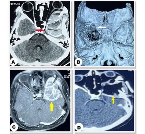 A Preoperative Axial Image Of Ncct Head Showing A Large Heterogeneous
