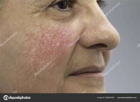 What Are Red Cheeks A Symptom Of