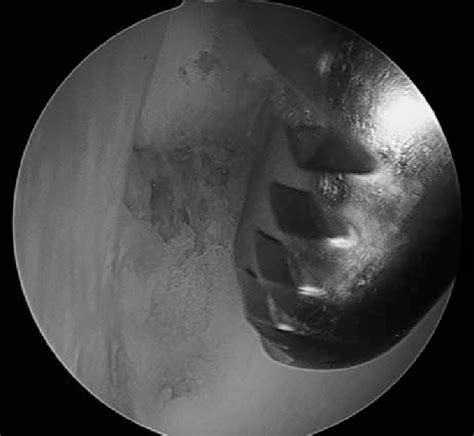Arthroscopic Image Of Acetabular Cartilage Lesion Undergoing