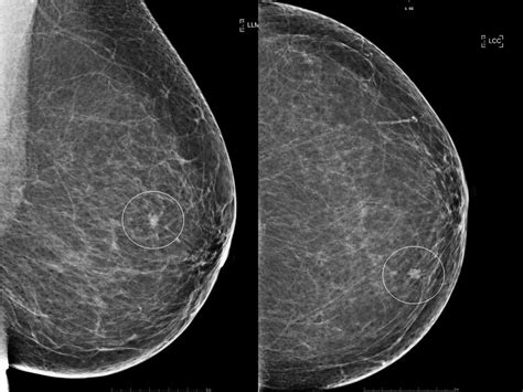 Plain X Ray Mammograms Demonstrating A Small Spiculated Mass Circled Download Scientific