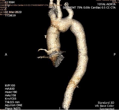 Surgical Treatment Of The Ascending Aorta Giant Aneurysm