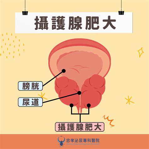 攝護腺肥大手術費用落差大，為何要選雷射手術？