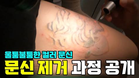 문신 잉크가 많아서 울퉁불퉁한 컬러 문신 제거 과정을 공개합니다 Youtube