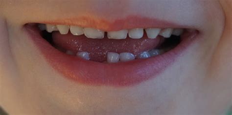 How To Close The Gap Between Your Teeth 8 Beneficial Ways 2025