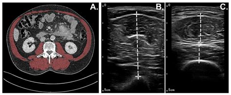 Example Muscle Mass Measurements A Total Skeletal Muscle Area On The Download Scientific