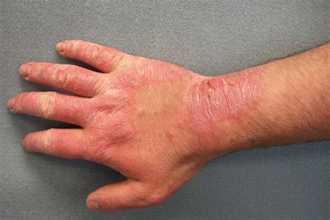 Dermatitis Types And Treatment Options