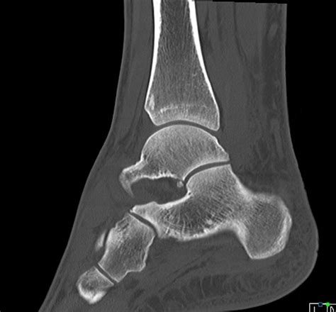 Posterior Talus Fracture Cedell Fracture Posterior Talar Process