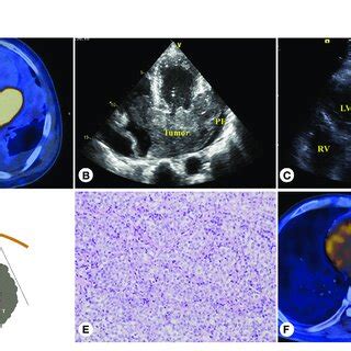 Sixty Five Year Old Male Patient Diffuse Large B Cell Lymphoma Of The Download Scientific