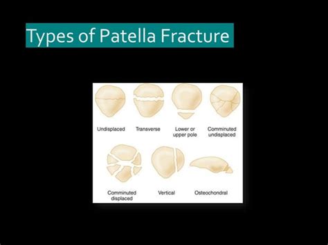 Patella Fracture Pptx