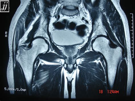 Abdomen Hematoma On The Right Gluteal Muscle 3 Radioogle