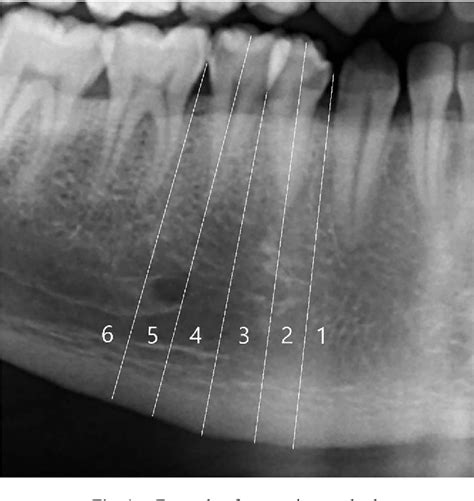 Figure 1 From A Radiographic Analysis Of The Location Of The Mental