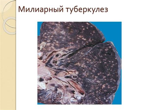 Туберкулез легких презентация онлайн