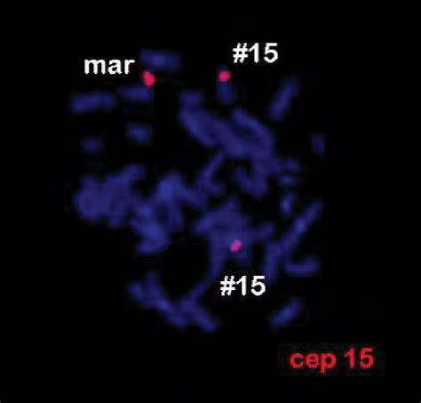 Fluorescence In Situ Hybridization Fish On Metaphase Shows Three
