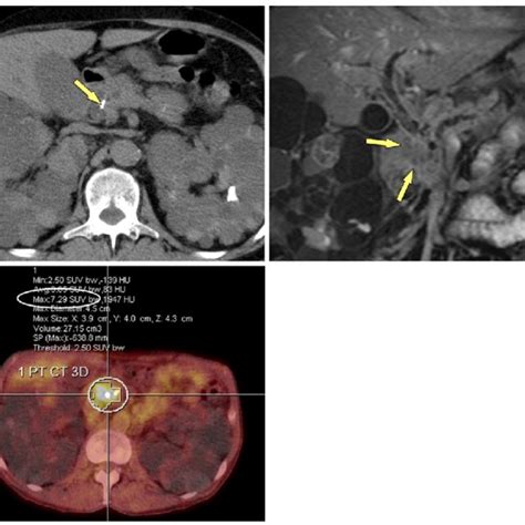 Pdf Mass Forming Pancreatitis Versus Pancreatic Ductal Adenocarcinoma