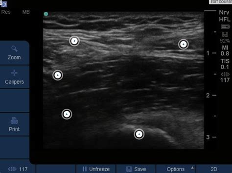 Fascia Iliaca Diagram Quizlet
