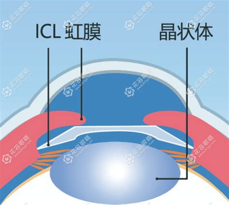 近视眼手术医生免费咨询 问诊预约挂号全 半飞秒 晶体植入 ICL晶体植入 花容眼睛