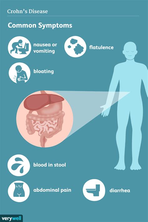 The Most Telling Crohns Disease Symptoms To Watch For