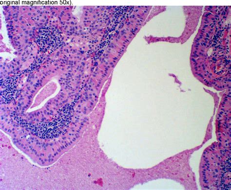 Figure 1 From Evaluation Of Cystic Salivary Gland Lesions By Fine