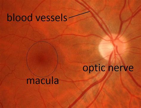 Cataracts Diagnosis And Treatment In Elmhurst Il Skowron Eye Care