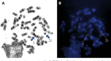 Figure 1 From Acute Myeloid Leukemia M 2 With A Cryptic Runx 1 Runx Semantic Scholar