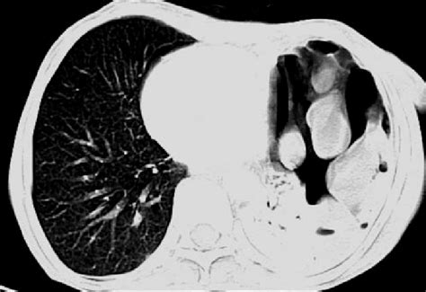 Contrast Enhanced Computed Tomography Scan Of The Thorax Showing