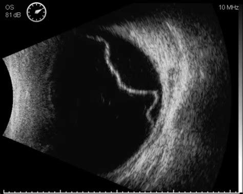 B Scan Ultrasound Ab Scan For Ophthalmology With Trolley And Printer