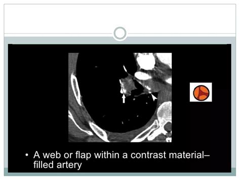Pulmonary Embolism Radiology Pptx