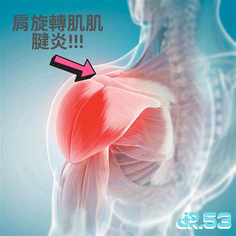 奧運隊醫林頌凱醫師 【53講堂】認識肩旋轉肌肌腱炎 ⚠️症狀 手臂向上舉起或旋轉時會產生疼痛，