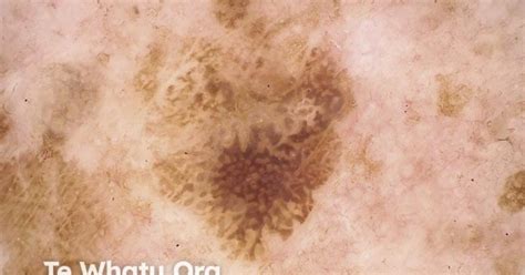 Seborrhoeic Keratosis Polarised Dermoscopy View Image