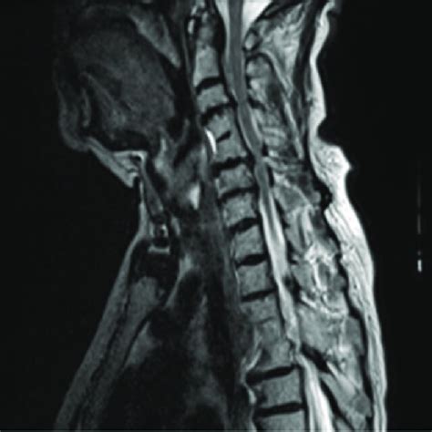 The Csf Dynamic Mri Showing Small Vascular Disease And Encephalomalacia